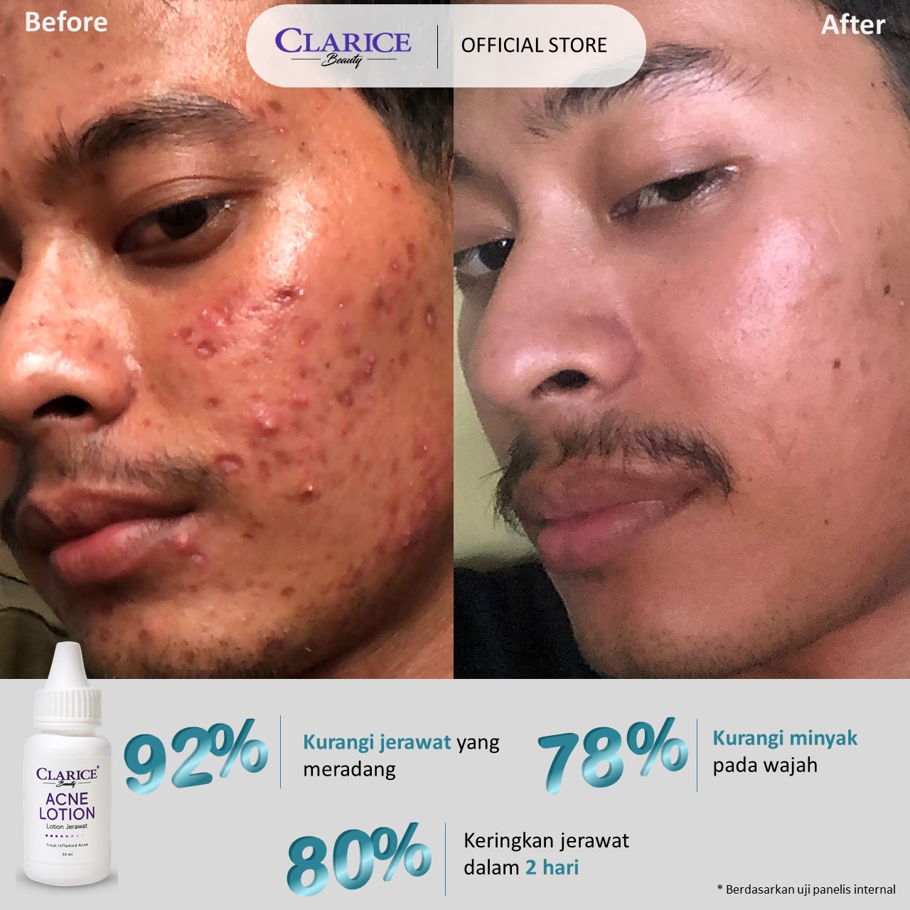 ACNE LOTION | Clarice Beauty
