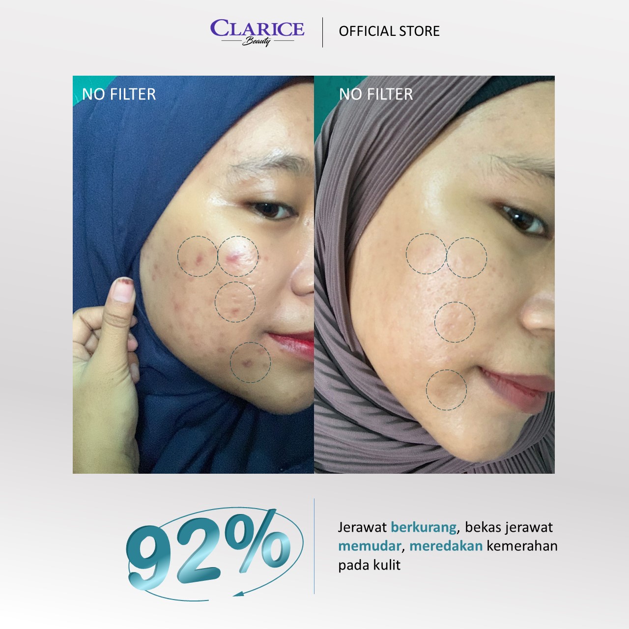 ACNE CARE SOLUTION | Clarice Beauty