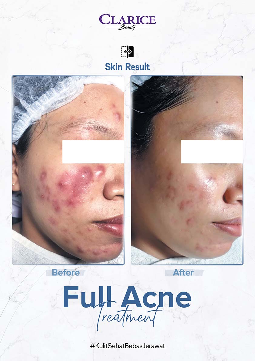 BA ACNE | Clarice Beauty