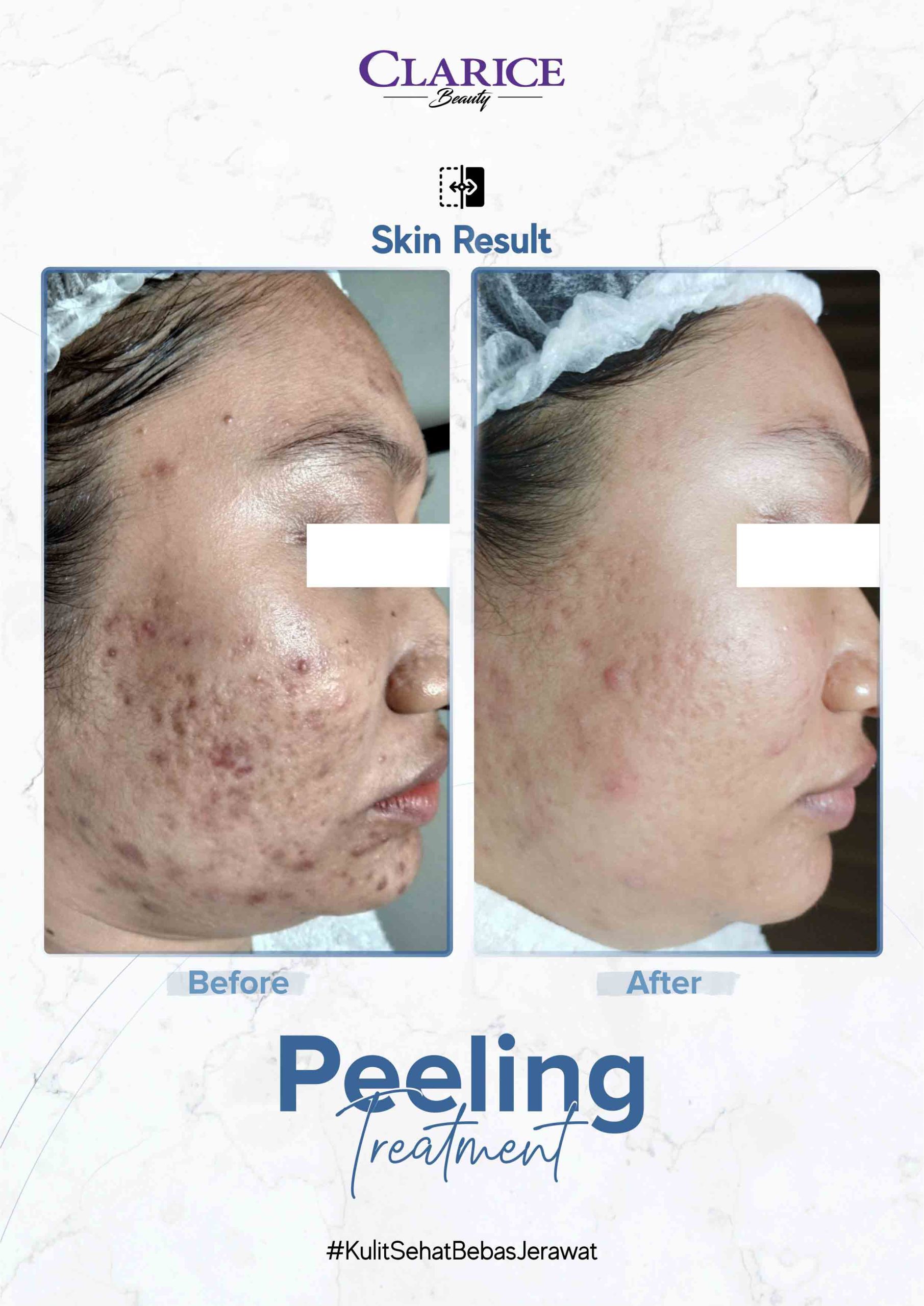 PEELING TREATMENT | Clarice Beauty