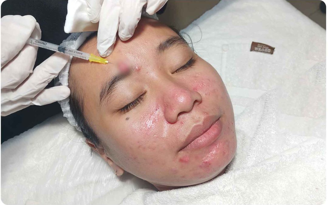 Acne Treatment | Clarice Beauty