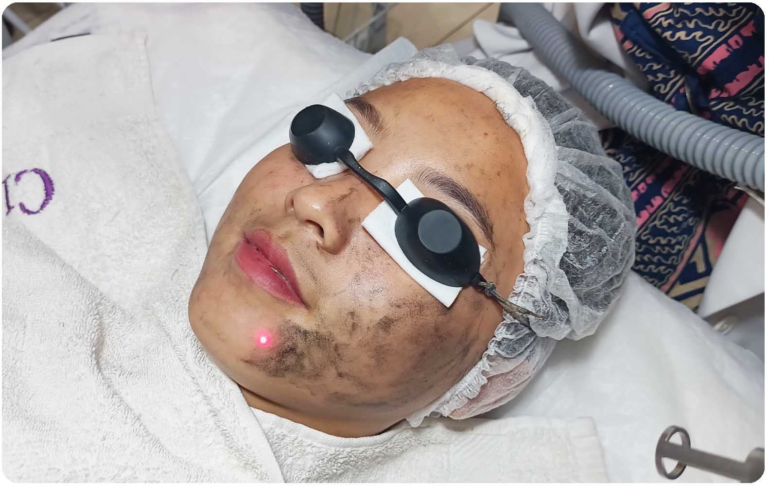 LASER TREATMENT | Clarice Beauty